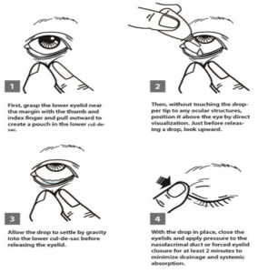 How to Use Eye Drops Properly | Shekar Eye Hospital