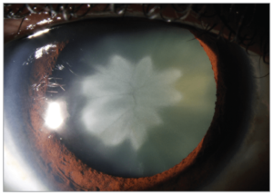 Impact of Fire Crackers on your eyes | Shekar Eye Hospital