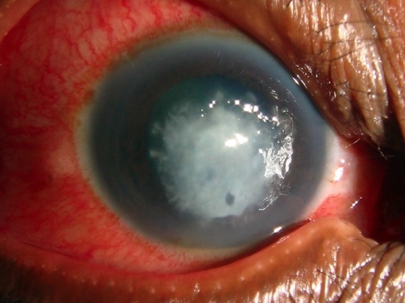 Corneal Ulcer (Keratitis): Causes, Symptoms, Diagnosis and Treatment