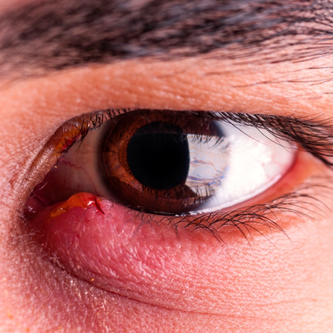 Stye Eye: Causes, Symptoms, Treatments | Shekar Eye Hospital