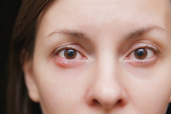 Stye Eye: Causes, Symptoms, Treatments | Shekar Eye Hospital