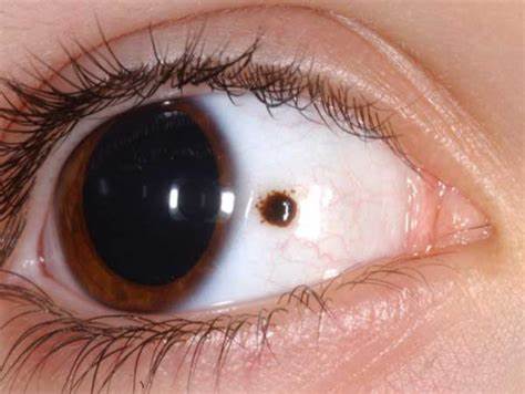 Ocular Melanoma | Causes, Symptoms, Treatments